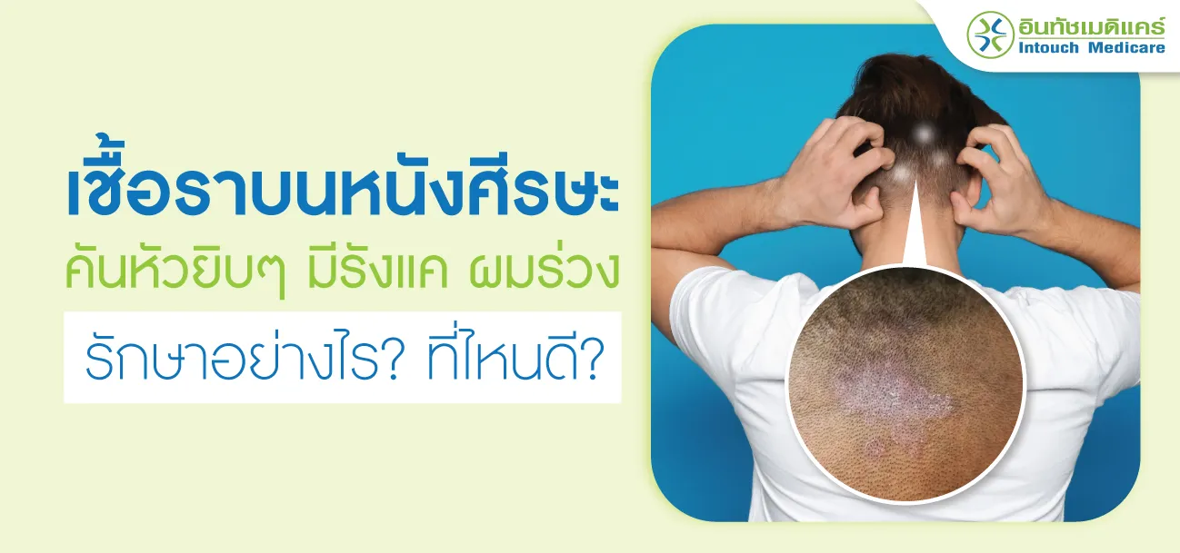 Tinea Capitis : Symptoms, Causes & Treatment - intouchmedicare