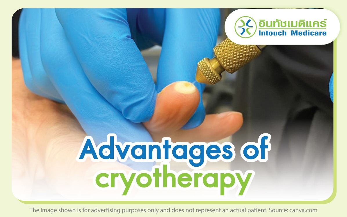 Cryotherapy (Freezing Treatment) Can Effectively Remove Warts and Skin ...