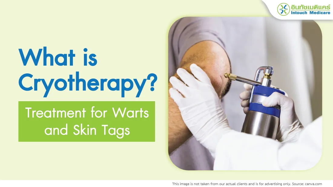 Cryotherapy (Freezing Treatment) Can Effectively Remove Warts and Skin ...