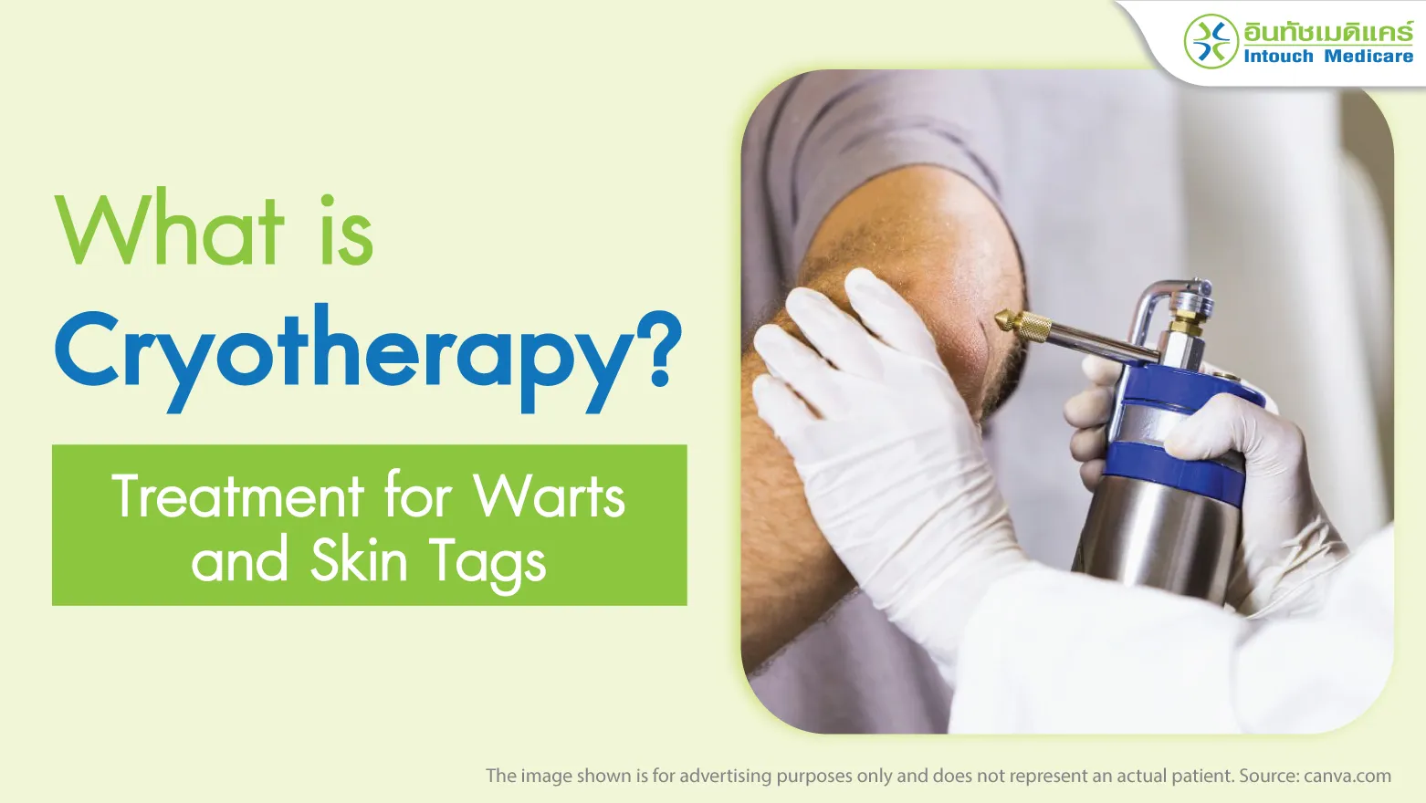Cryotherapy (Freezing Treatment) Can Effectively Remove Warts and Skin ...